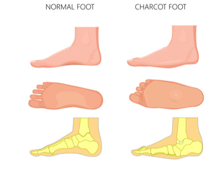 What is Charcot Foot? Symptoms and Treatment – Insoles.com